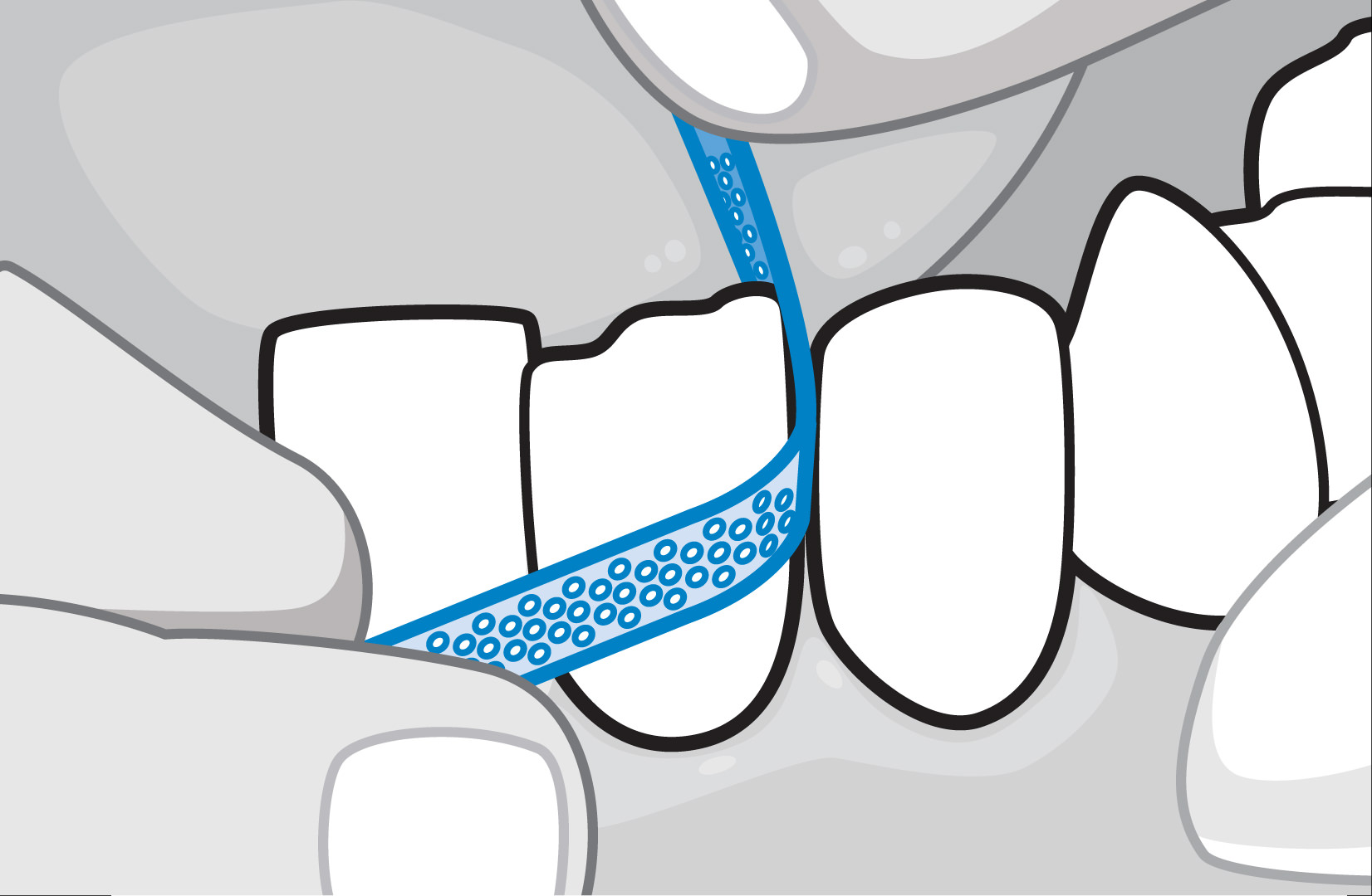 The Sacramento Dentistry Group Explains How IPR Makes Invisalign More ...